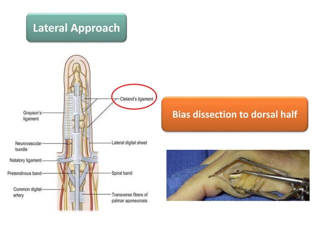 PIP joint approach | PPTX