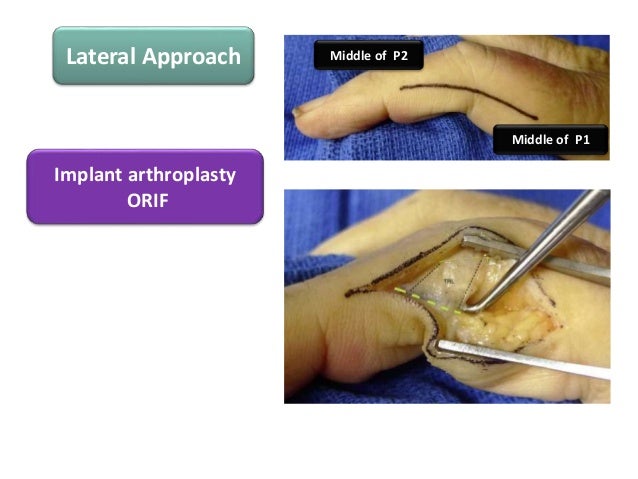 PIP joint approach
