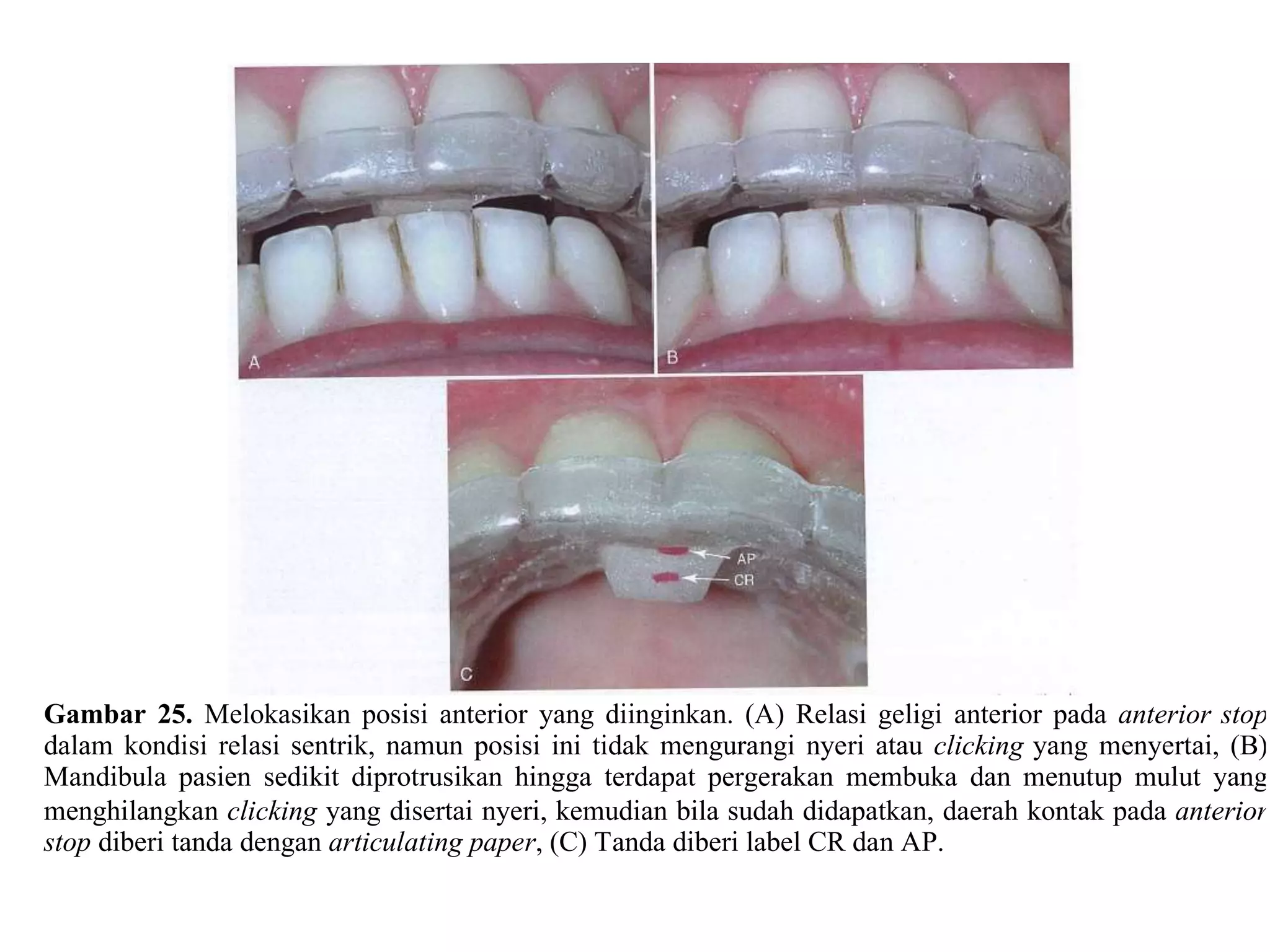 PIRANTI OKLUSAL.pptx