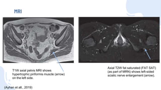 Referat / Pengayaan Piriformis syndrome | PPTX