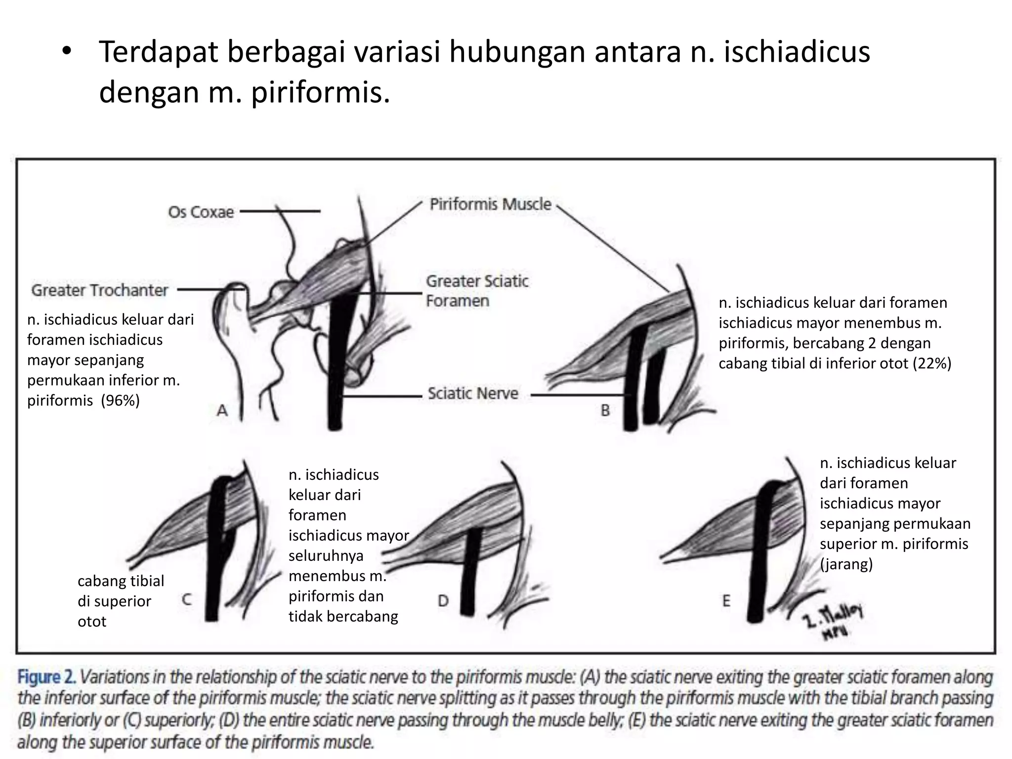 Piriformis Syndrome, Lumbar Spinal Stenosis, Lumbar Facet Joint Pain | PPTX