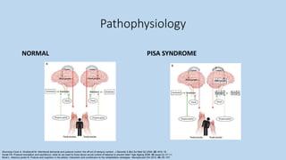 Pisa Syndrome | PPTX