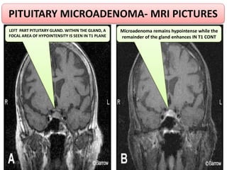 PITUITARY ADENOMA RADIOTHERAPY PLANNING | PPTX