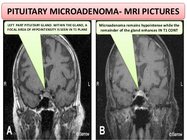 Radiation For Pituitary Tumor All About Radiation