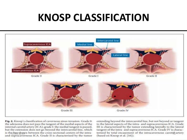 PITUITARY ADENOMA RADIOTHERAPY PLANNING