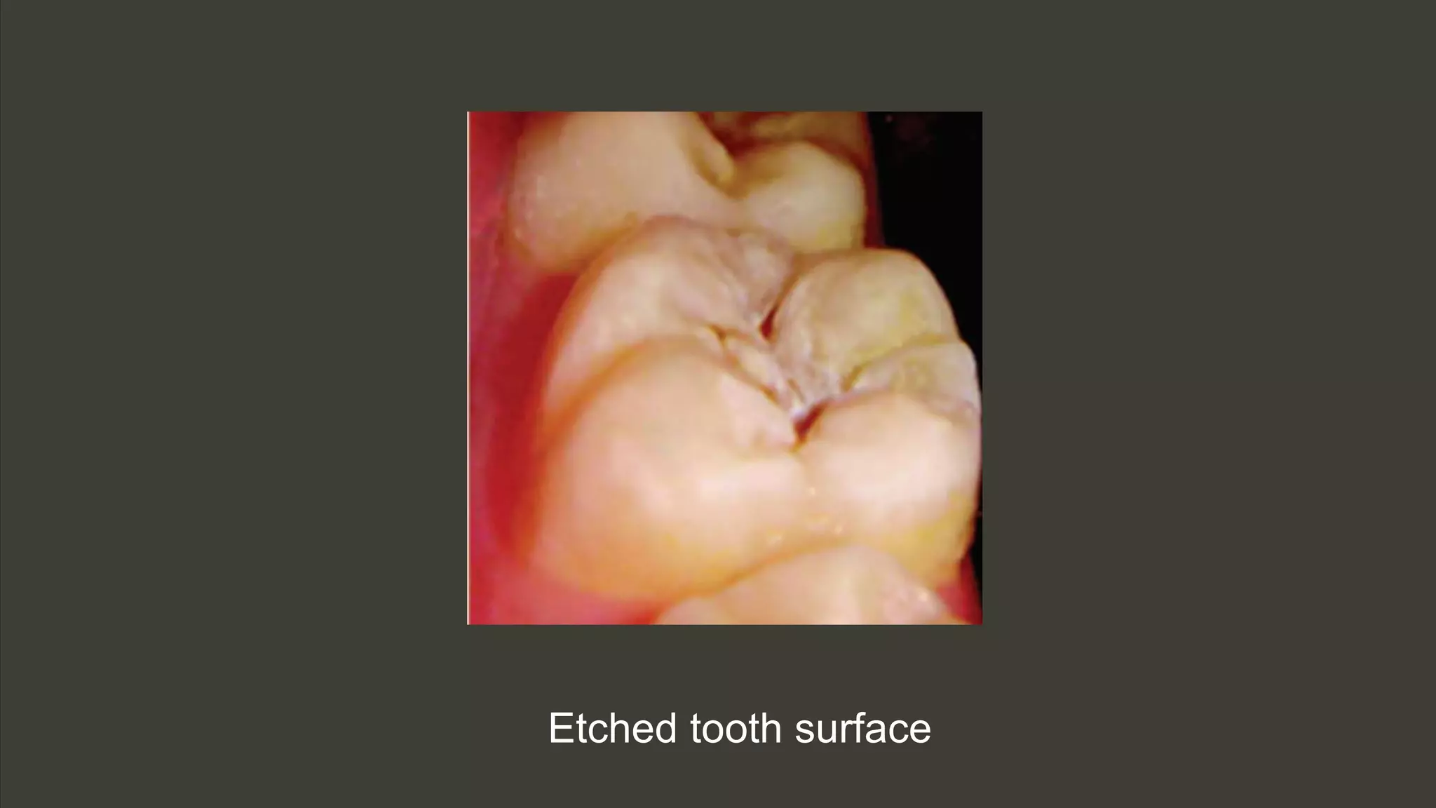 Pit and fissures Sealants | PPTX