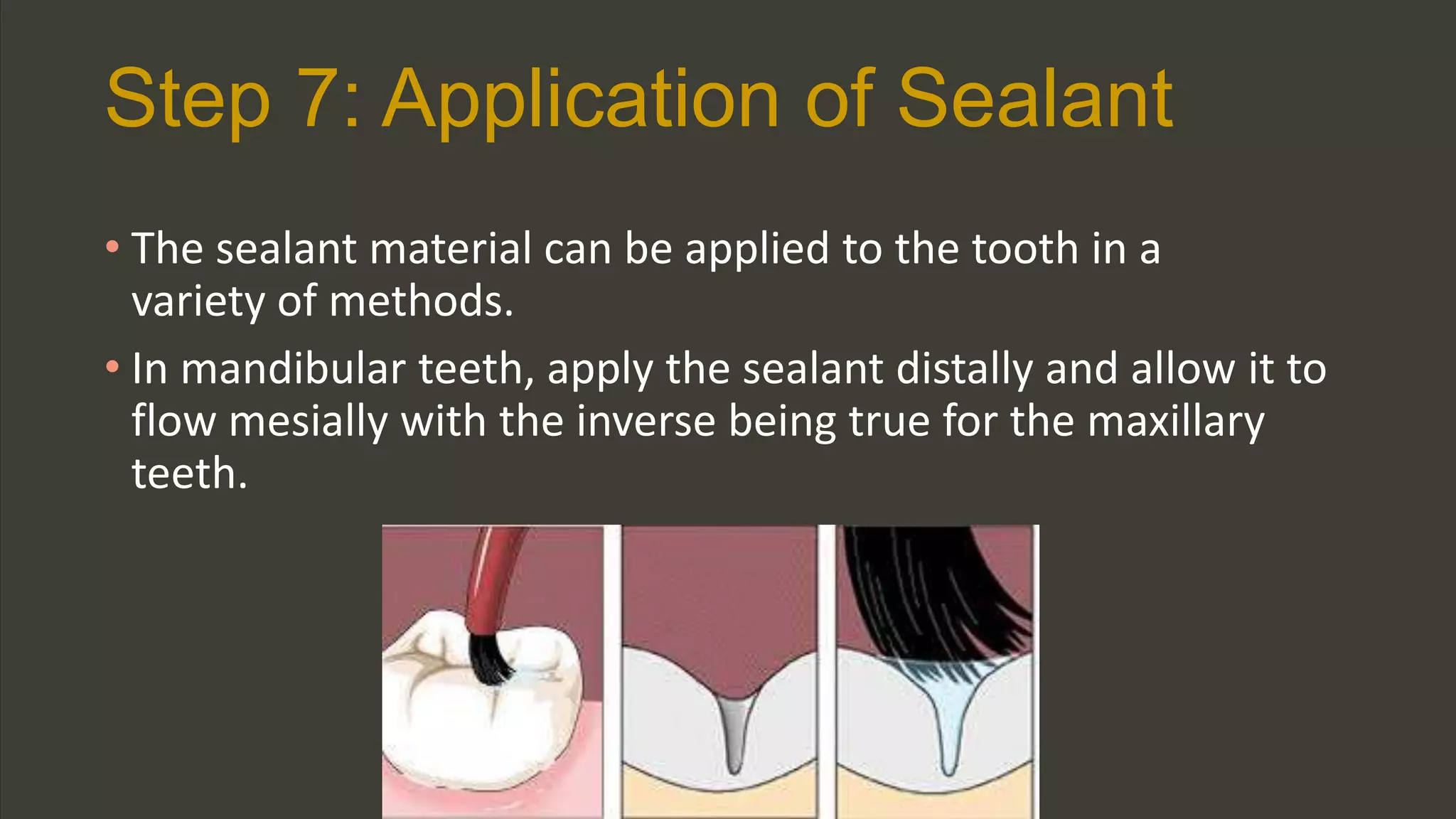 Pit and fissures Sealants | PPTX
