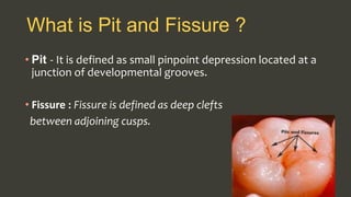 Pit and fissures Sealants | PPTX