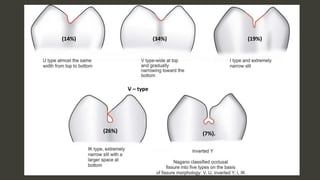 Pit and fissures Sealants | PPTX