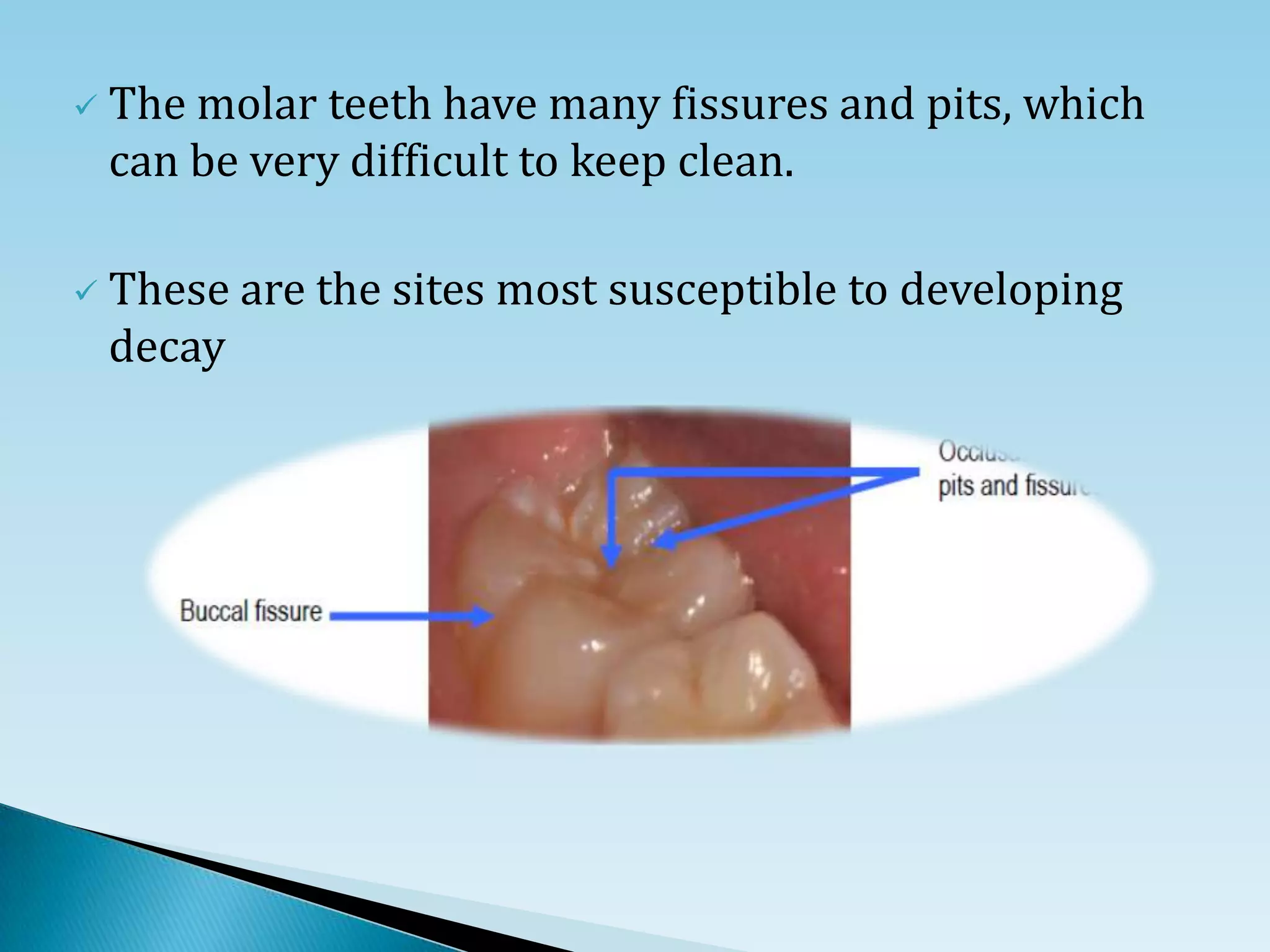 Pit and fissure sealant | PPTX