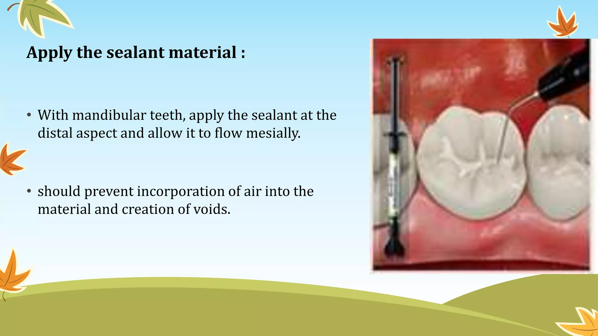 Pit and fissure sealant | PPTX