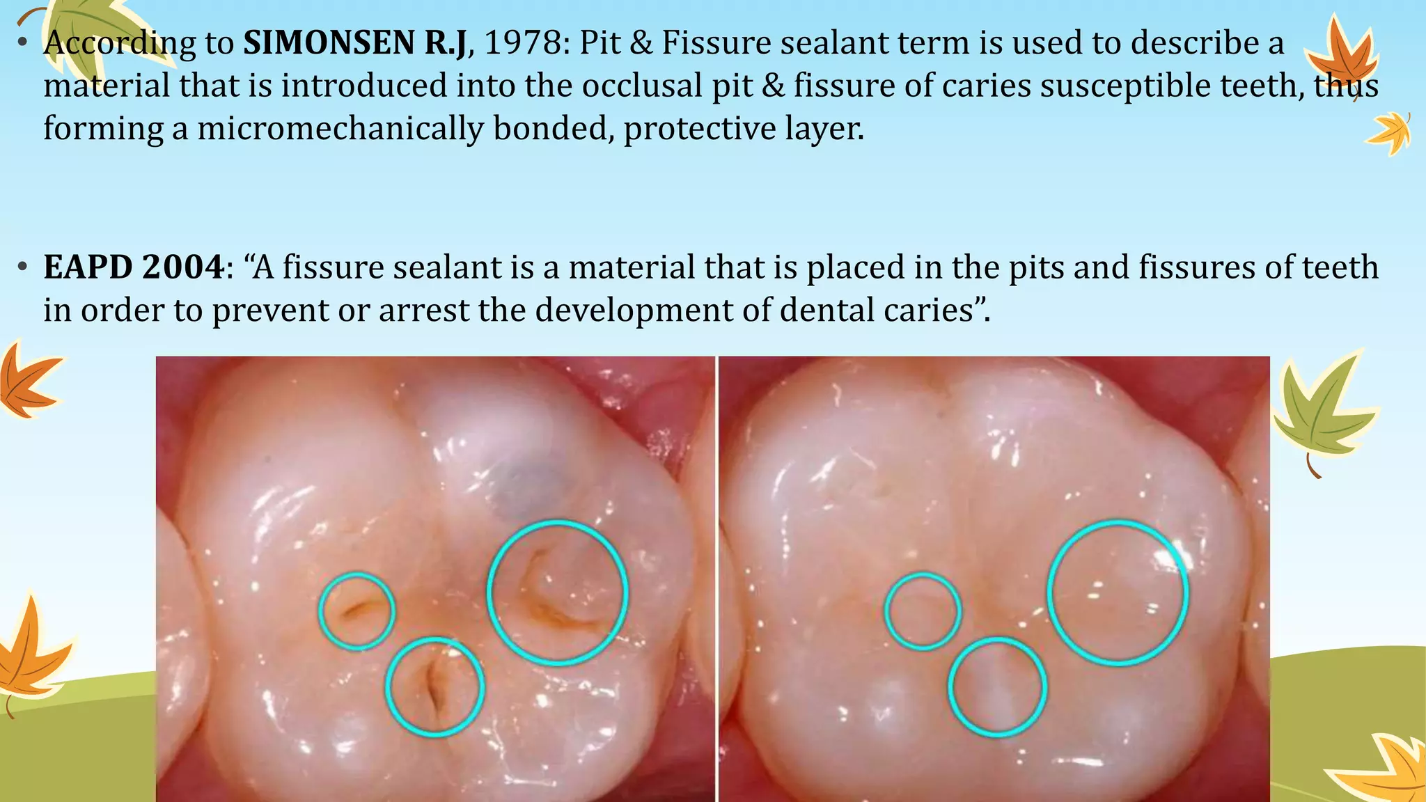Pit and fissure sealant | PPTX