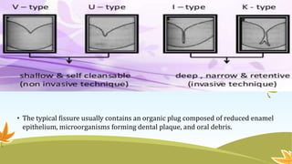 Pit and fissure sealant | PPTX