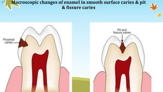 Pit and fissure sealant | PPTX