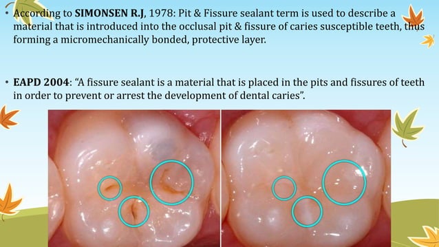 Pit and fissure sealant | PPTX | Dental Health | Diseases and Conditions