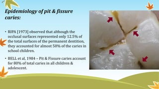 Pit and fissure sealant | PPTX