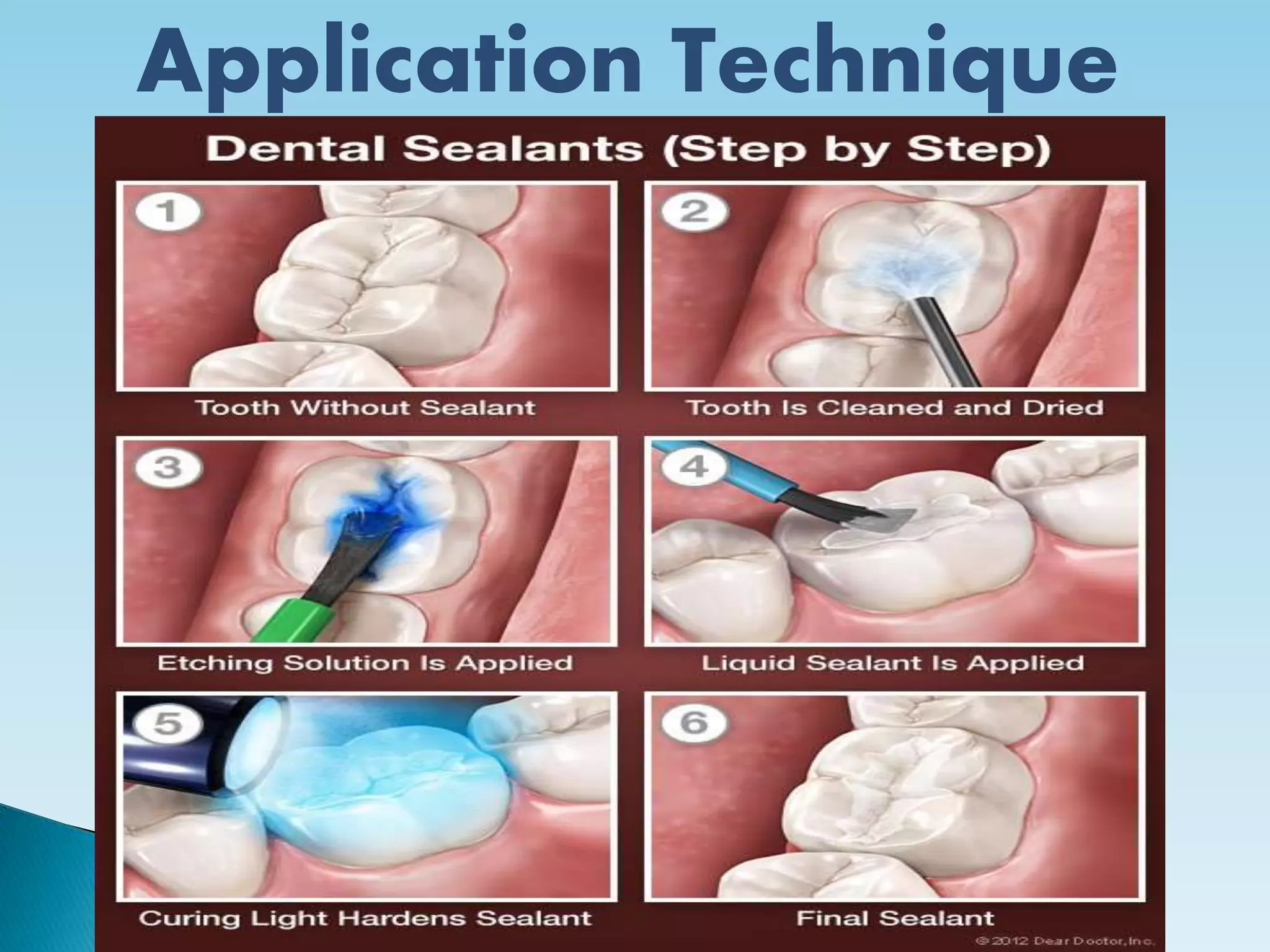 Pit and Fissure sealants | PPTX
