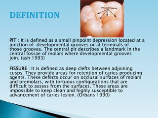 Pit and Fissure sealants | PPTX