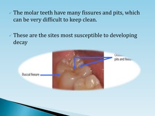 Pit and Fissure sealants | PPTX