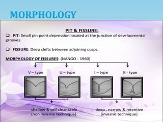 Pit and Fissure sealants | PPTX