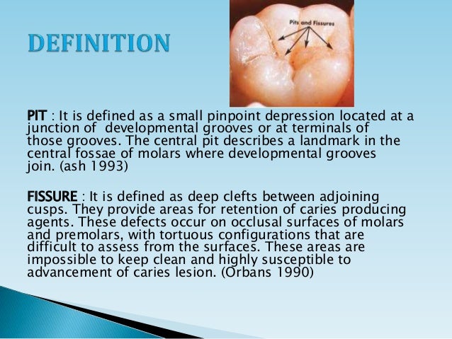 Pit and Fissure sealants