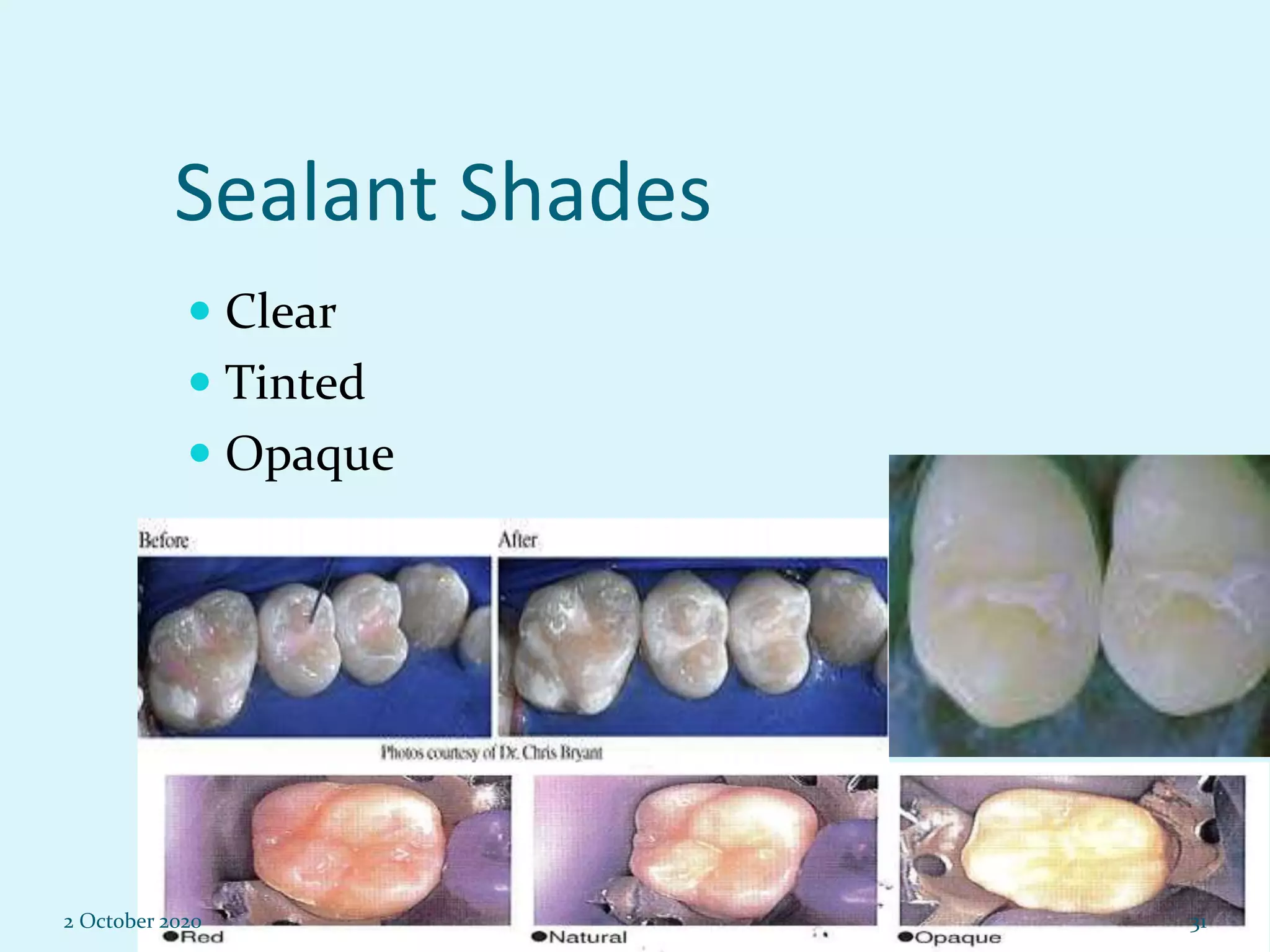 Pit and fissure sealant | PPTX
