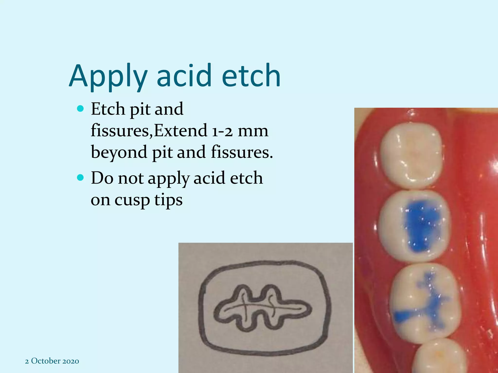 Pit and fissure sealant | PPTX