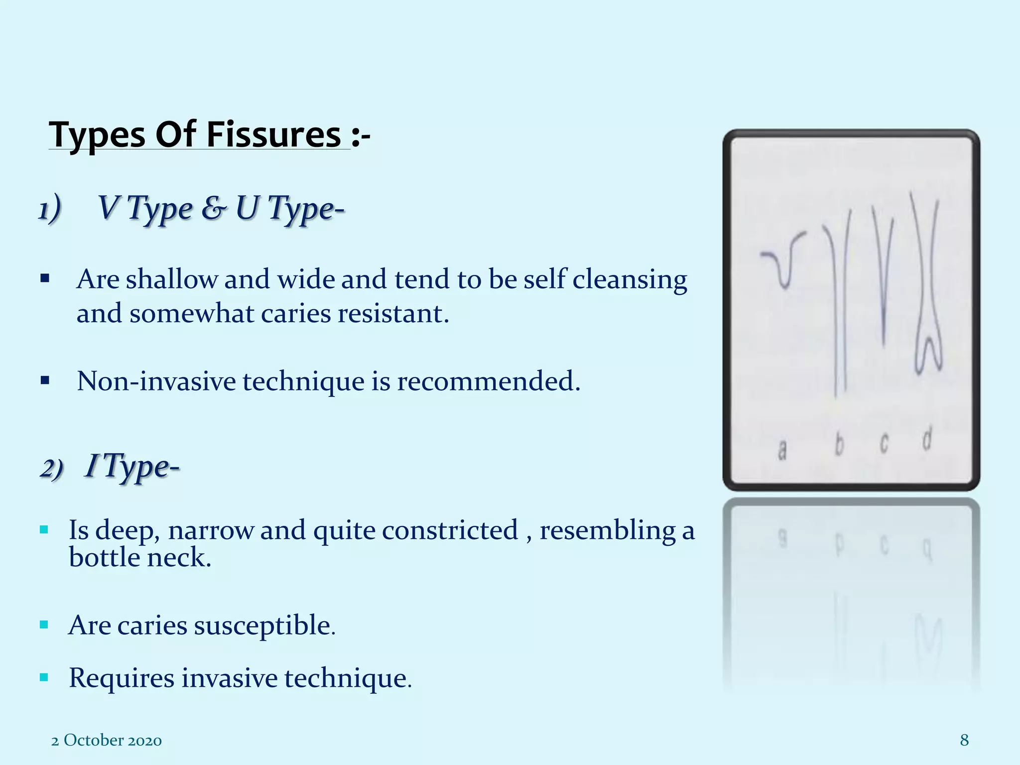 Pit and fissure sealant | PPTX