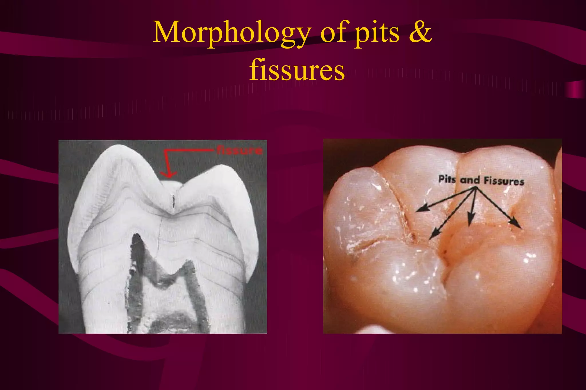 Pit and fissure sealants | PPT