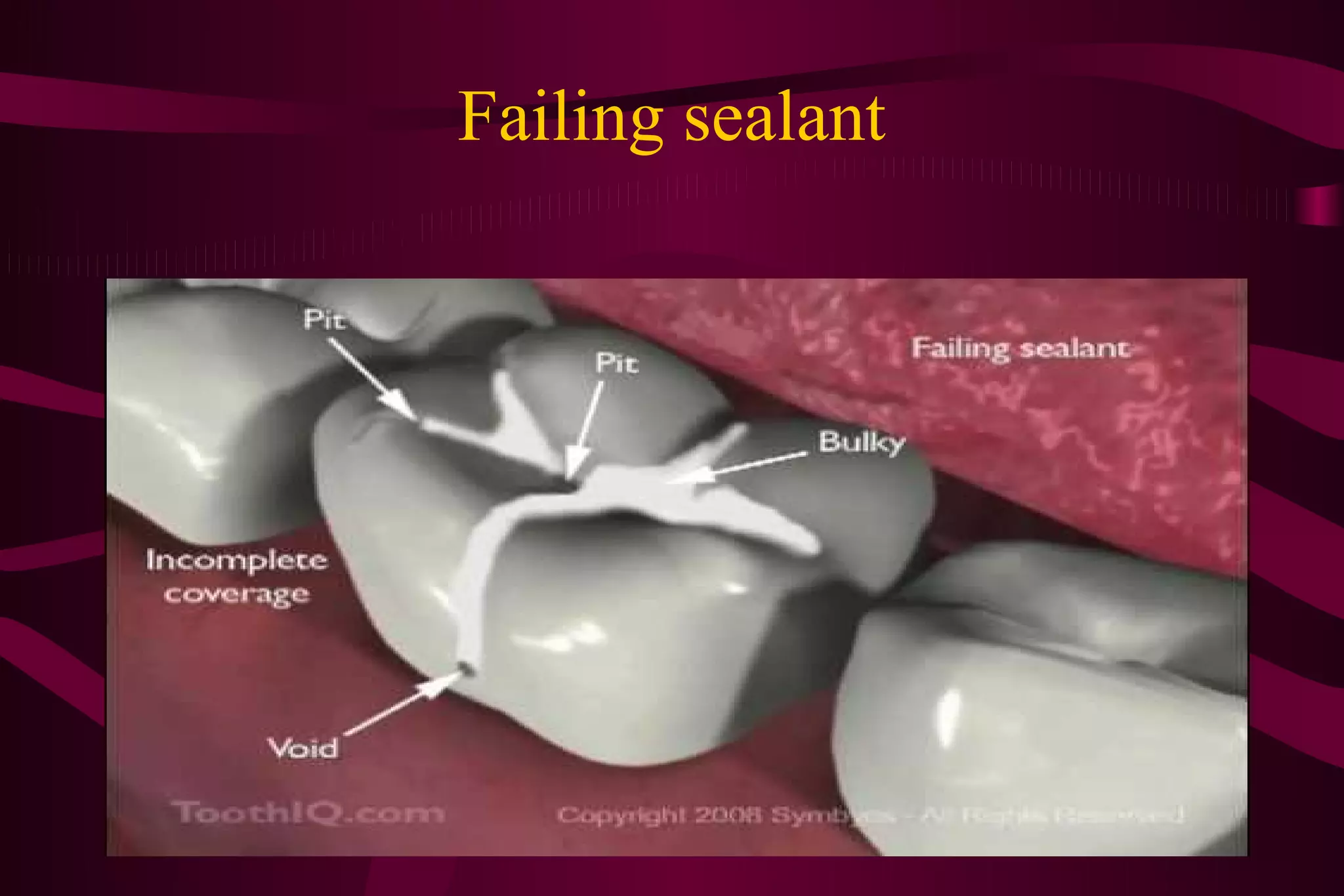 Pit and fissure sealants | PPT