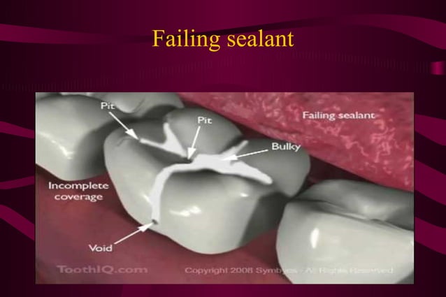 Pit and fissure sealants | PPT | Oral care | Personal Care