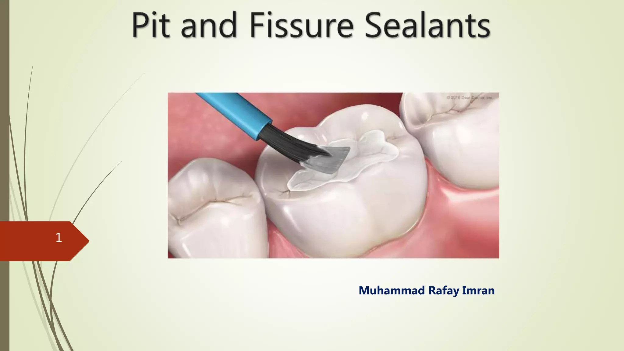 Pit and fissure sealants | PPTX | Dental Health | Diseases and Conditions