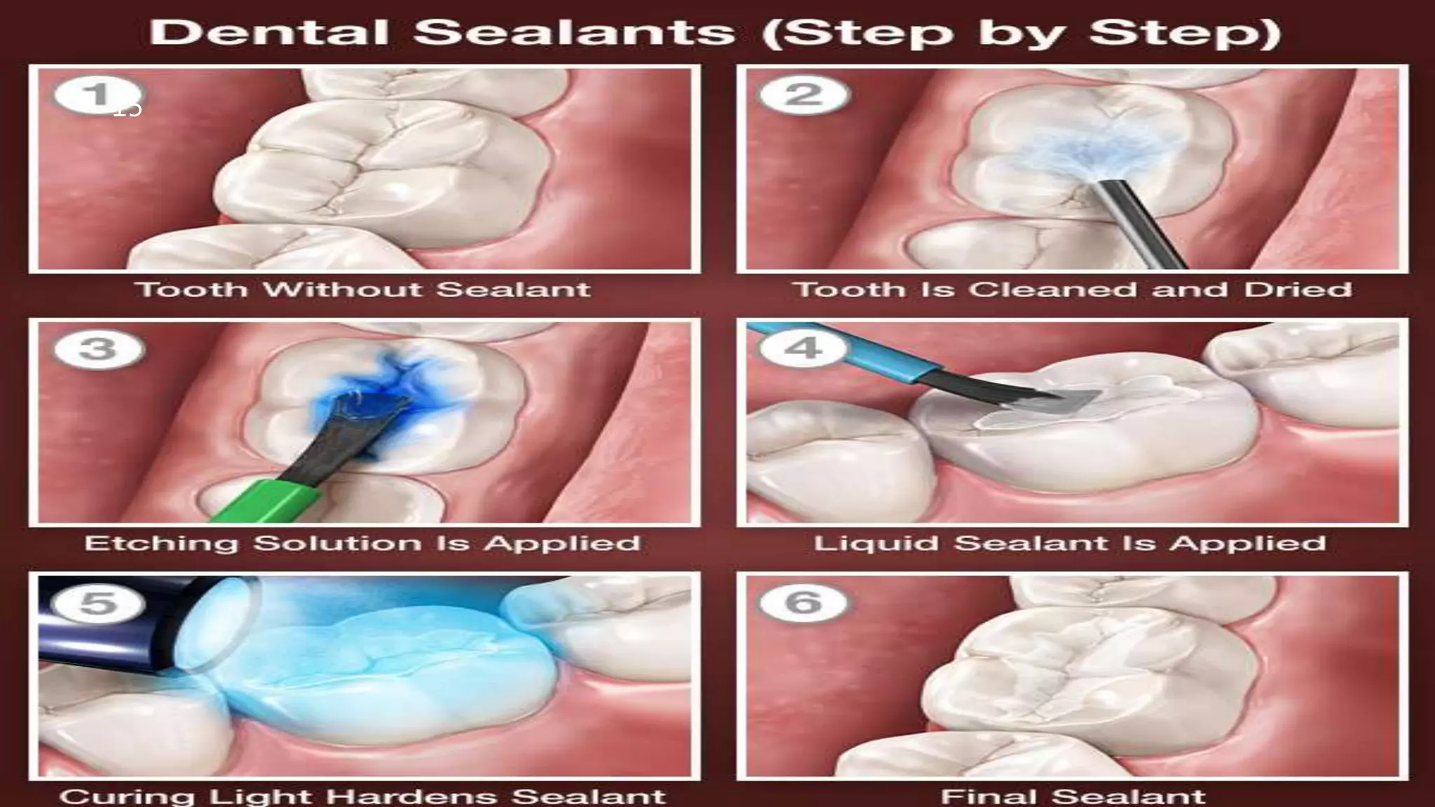 Pit and fissure sealants | PPTX | Dental Health | Diseases and Conditions