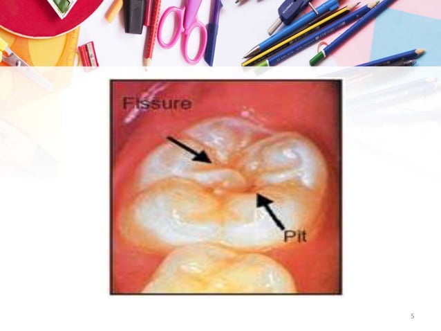 Pit and fissure sealants | PPT
