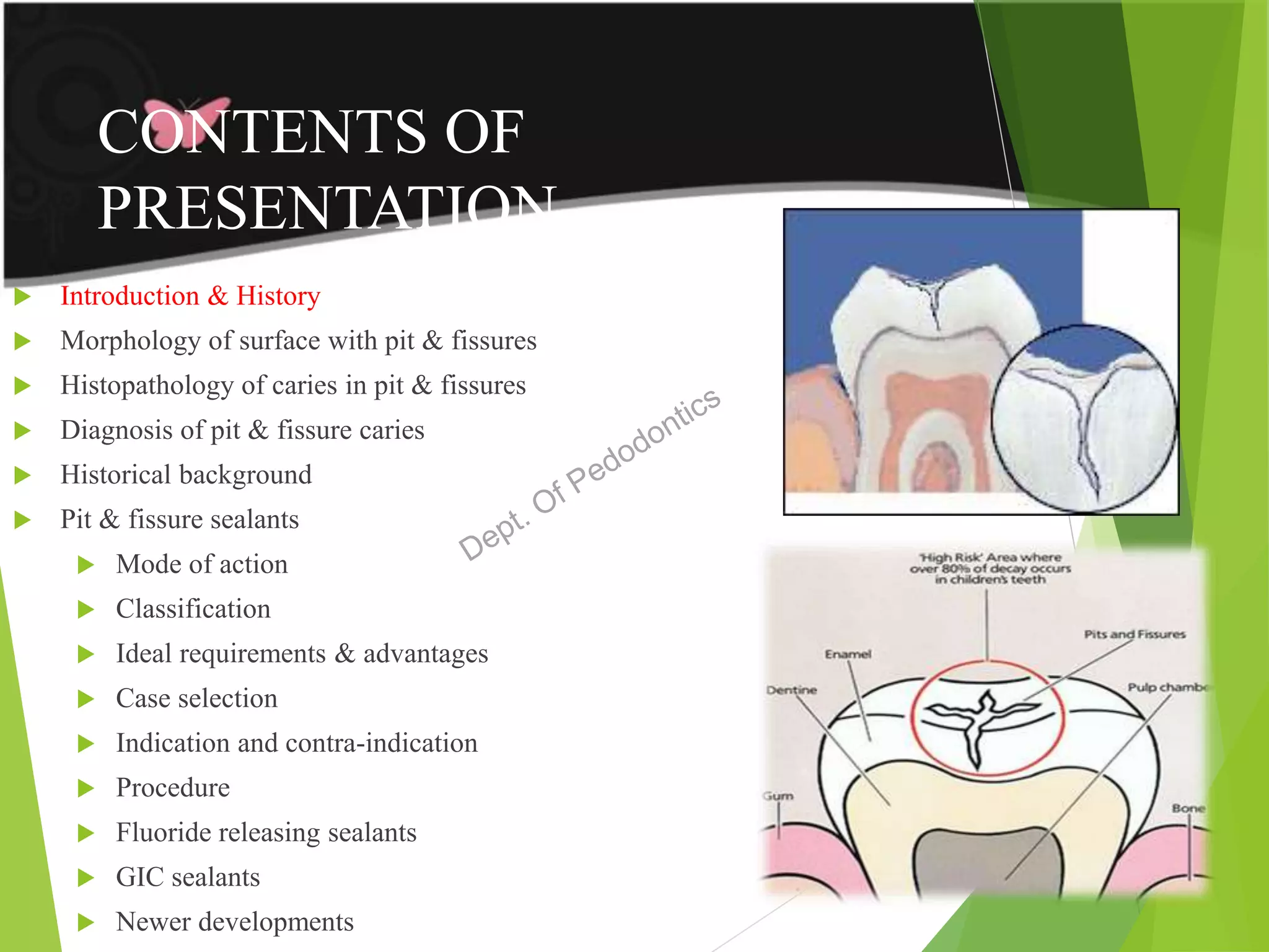 Pit and fissure sealants | PPTX