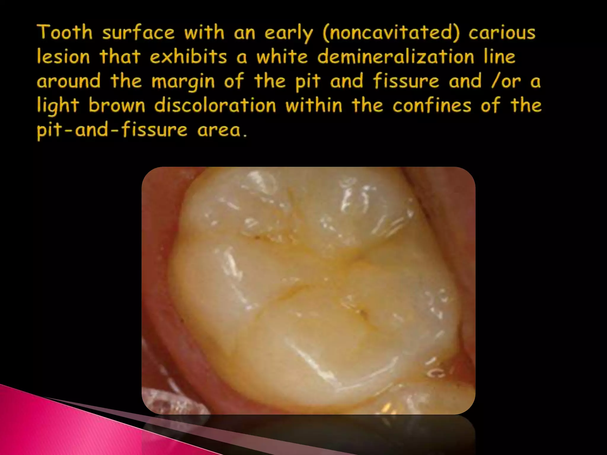 Pit and fissure sealants | PPTX