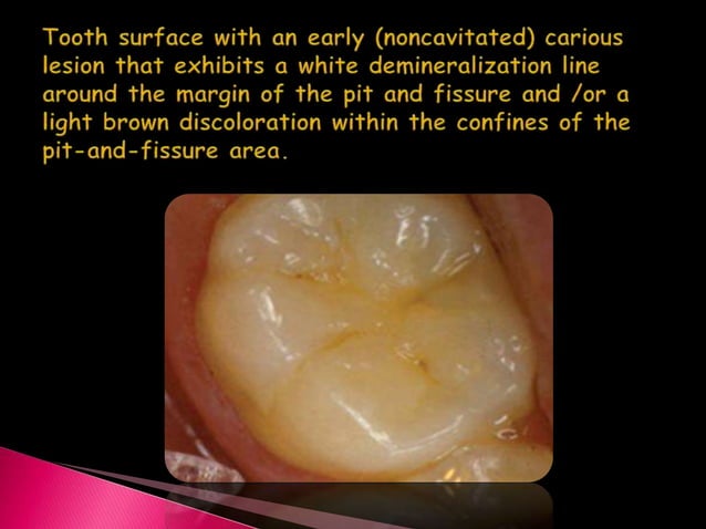 Pit and fissure sealants | PPTX
