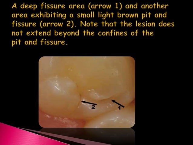 Pit and fissure sealants | PPTX