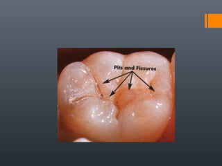 Pit and fissure sealants | PPTX