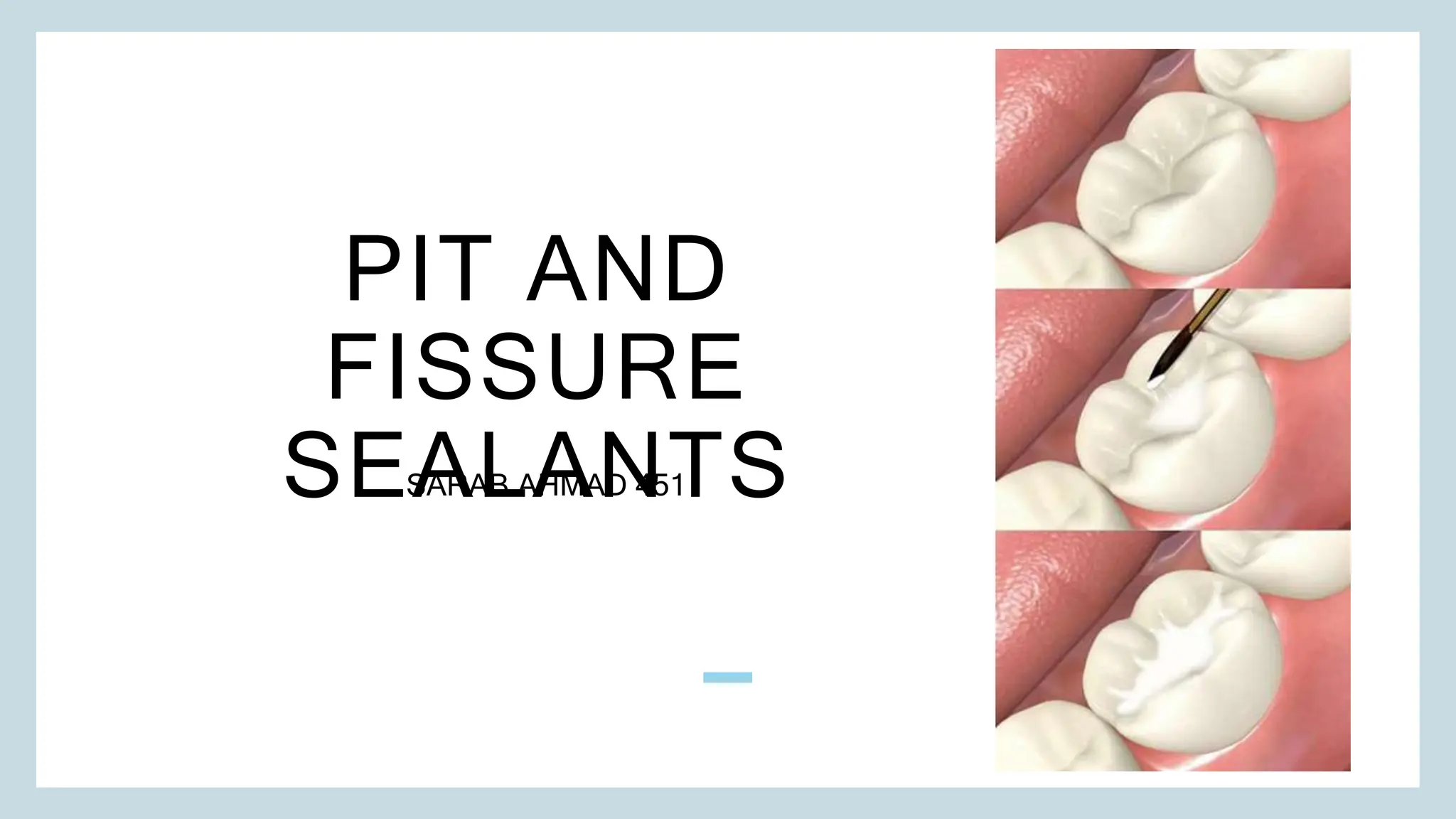 pit and fissure sealants FOR DENTAL .pptx