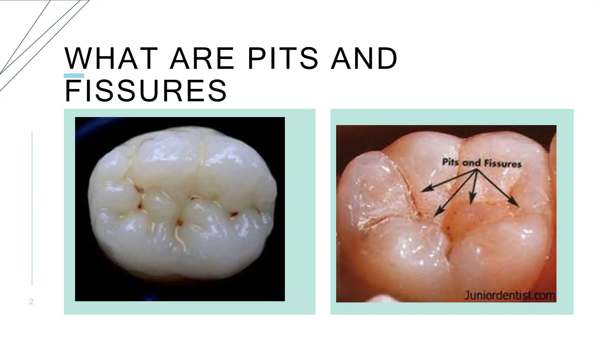pit and fissure sealants FOR DENTAL .pptx