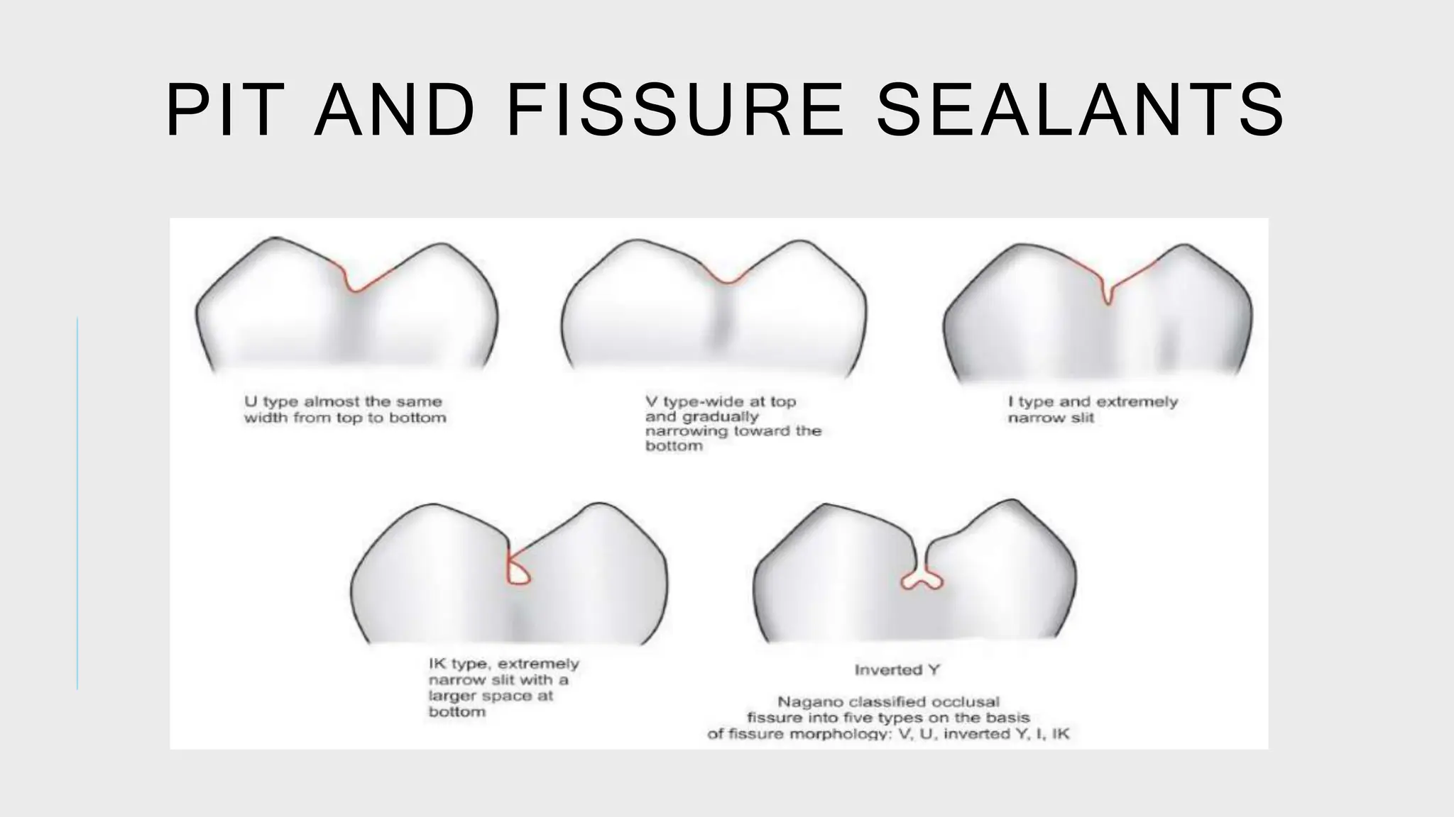 pit and fissure sealants FOR DENTAL .pptx