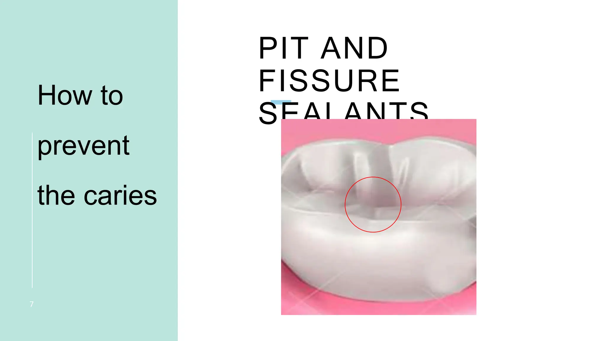 pit and fissure sealants FOR DENTAL .pptx