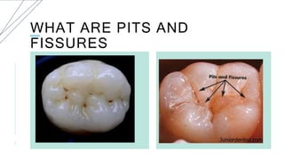 pit and fissure sealants FOR DENTAL .pptx