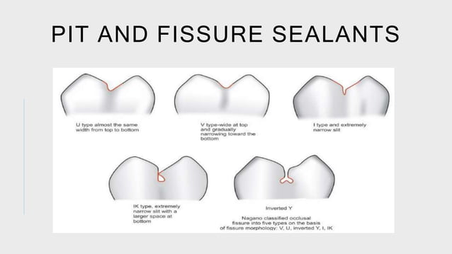 pit and fissure sealants FOR DENTAL .pptx