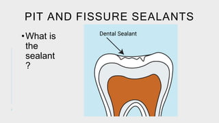 pit and fissure sealants FOR DENTAL .pptx