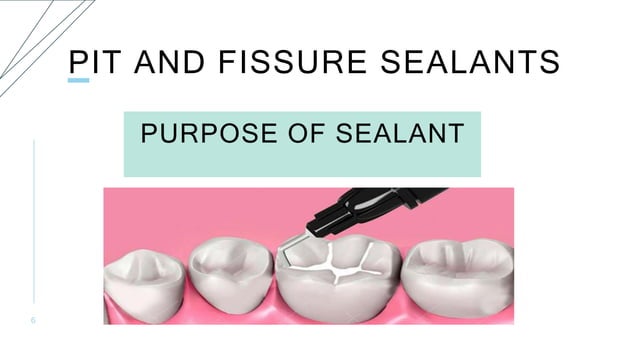 pit and fissure sealants FOR DENTAL .pptx