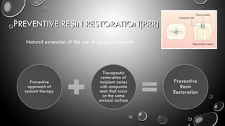 PIT AND FISSURE SEALANTS AND PREVENTIVE RESIN RESTORATIONS | PPT