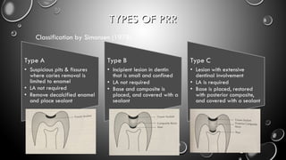 PIT AND FISSURE SEALANTS AND PREVENTIVE RESIN RESTORATIONS | PPT