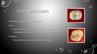 PIT AND FISSURE SEALANTS AND PREVENTIVE RESIN RESTORATIONS | PPT